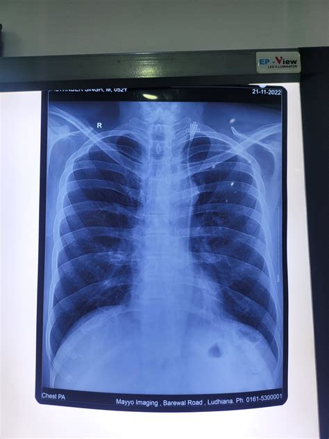 Dr Navdeep Dm Medical Oncology Aiims New Delhi On Twitter My Intensivist Put A Left Ijv