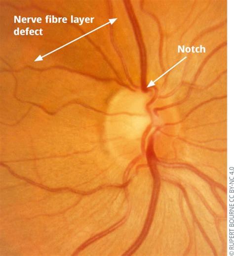 The Optic Nerve Head In Ophthalmology Notes And Synopses