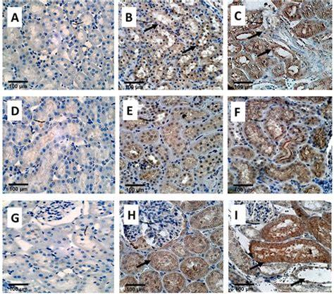 Transcriptional Study Of Hyperoxaluria And Calcium Oxalate