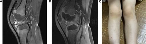 Pigmented Villonodular Synovitis