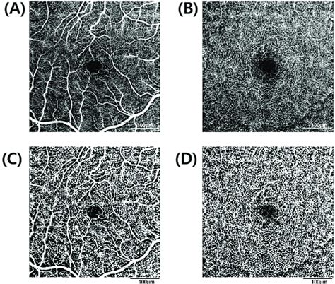 Measurement Of The Vascular Density Of The Superficial And Deep Retinal Download Scientific