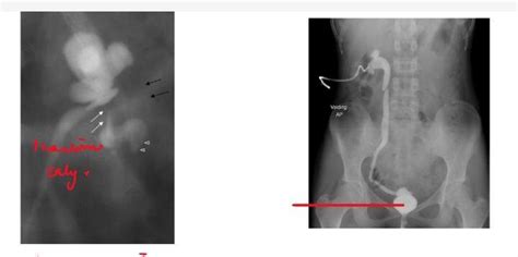 Micturating Cystourethrography Genitourinary Radiology