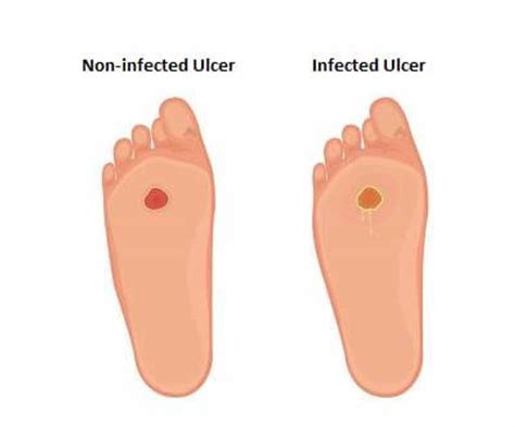 What Is An Ulcer On Foot Outlet