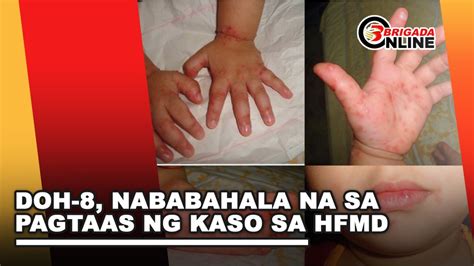 Doh 8 Nababahala Na Sa Pagtaas Ng Kaso Sa Hfmd Doh 8 Nababahala Na