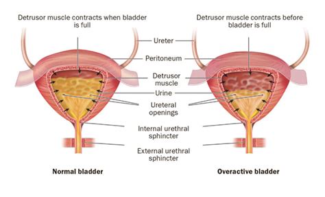 Navigating The Complexities Of Overactive Bladder Medical Independent