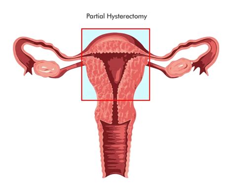 Laparoscopic Supracervical Hysterectomy Choosing The Route For Benign Uterine Disease