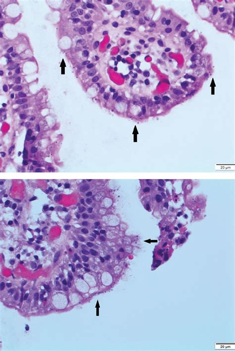 Cryptosporidiosis In An Immunosuppressed Patient With Persistent
