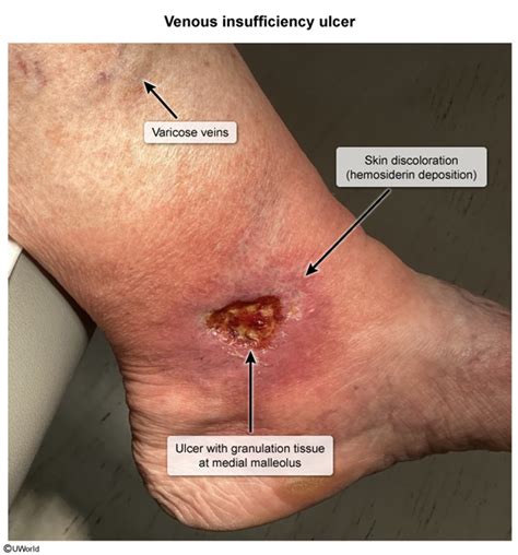 Pyoderma Gangrenosum Dermatology Uworld Medical Library