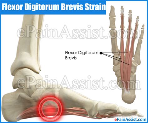 Flexor Digitorum Brevis Strain