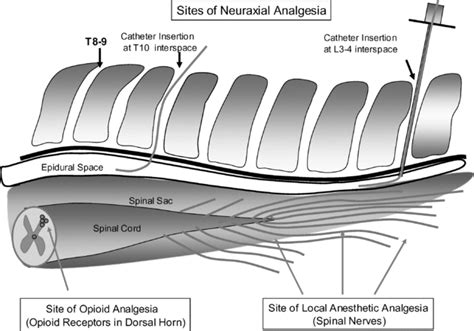 Intrathecal Vs Epidural Injection