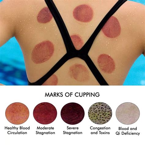 Cupping Therapy Type Method Procedure