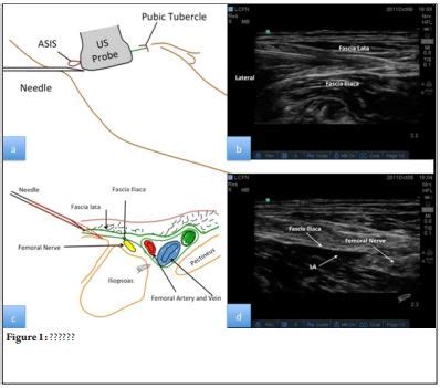 Lateral Femoral Cutaneous Nerve Block Ultrasound