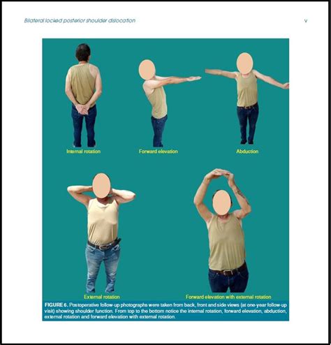 Yrd Doç Dr Murat Saylık Omuz Bilateral Locked Posterior Shoulder Dislocation Overlooked For