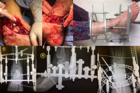 Ankle Arthrodiastasis In Conjunction With Treatment For Acute Ankle
