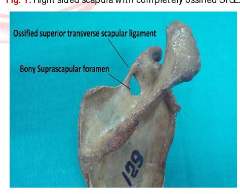 Transverse Scapular Ligament
