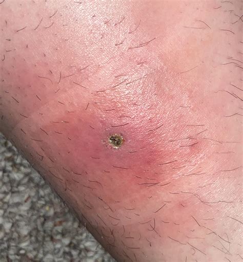 What Kind Of Bug Bite Is This My Friend Got Bit On His Leg And Is Starting To Get A Heat Like
