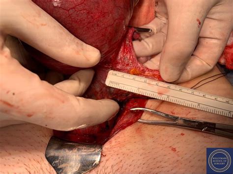 Complete Dissection Of The Left Parametrium Download Scientific Diagram