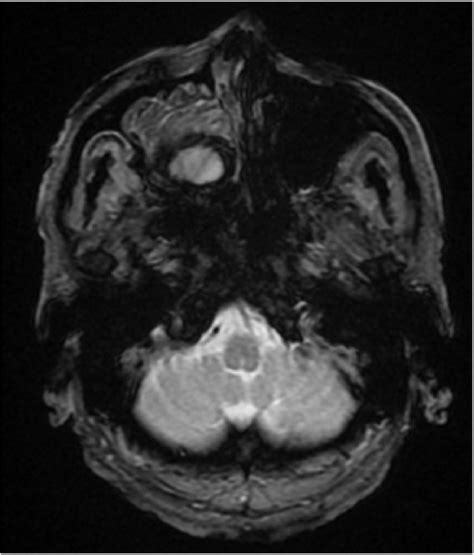 Mri T2 Image Shows A High Intensity Mass At The Right Maxillary Sinus