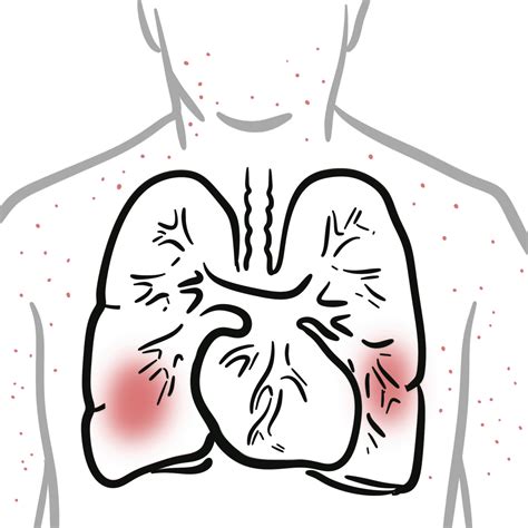 Caplan Syndrome Armando Hasudungan