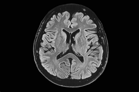 Schizophrenia Brain Scan