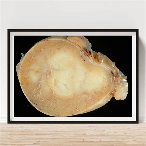 Gross Specimen Sectioned Testis With Seminoma Art Print By Science