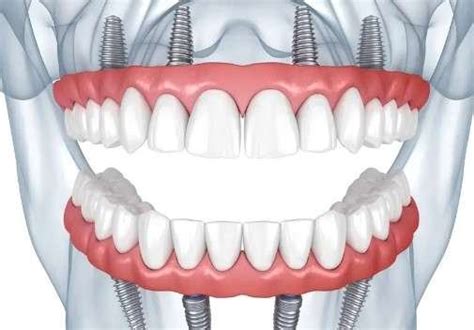 Upper Denture Implants Cost Richmond Hill Smile Centre We Customize