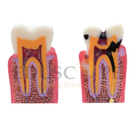 Dental Caries Tooth Model