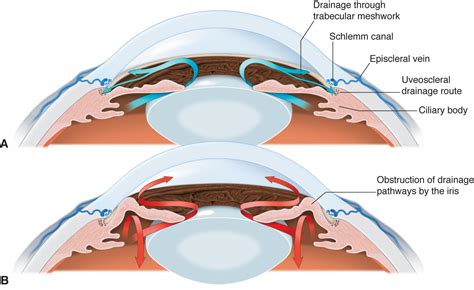 Hydraulic Fluid In Eyes At Michiko Durbin Blog