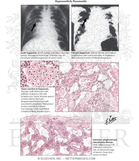 Hypersensitivity Pneumonia