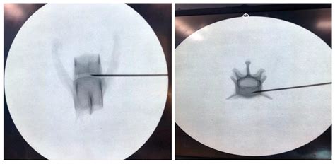 Evaluation Of Safe Insertion Angles For Spinal Needles And Safe