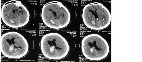 Case Report Of A Septum Pellucidum Cavernoma Surgically Resected Via