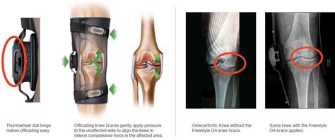 Breg Freestyle Oa Knee Brace Dme Direct