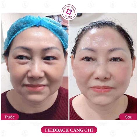 Dịch Vụ Căng Chỉ Tại Doctor Laser