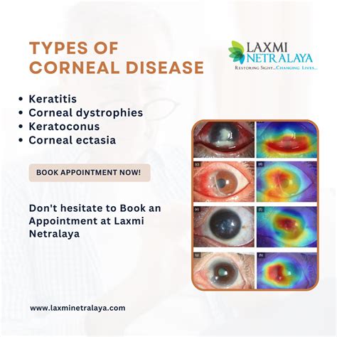 What Is Corneal Disease Laxmi Netralaya