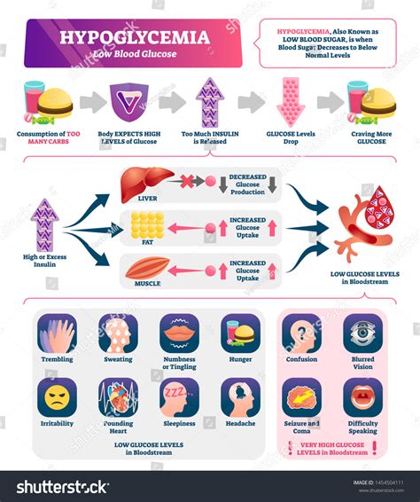 Hypoglycemia Vector Illustration Labeled Low Sugar Stock Vector
