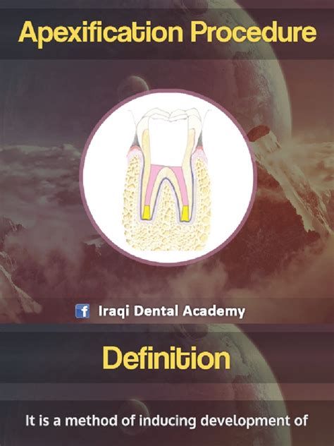 Apexification Procedure Rashed Pdf