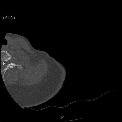 Avascular Necrosis Of The Shoulder Cruess Stage I Radiopaedia 77674 89887 Axial Bone Window
