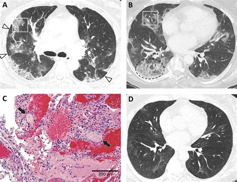 A Axial Ct Image Of The Mid Lung Zones Showing Areas Of Perilobular