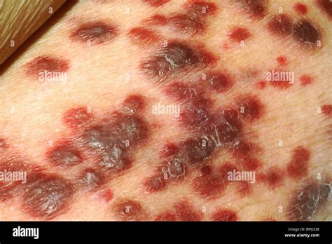 Sarcoma De Kaposis Unusual Case Of Hiv With Kaposi Sarcoma And