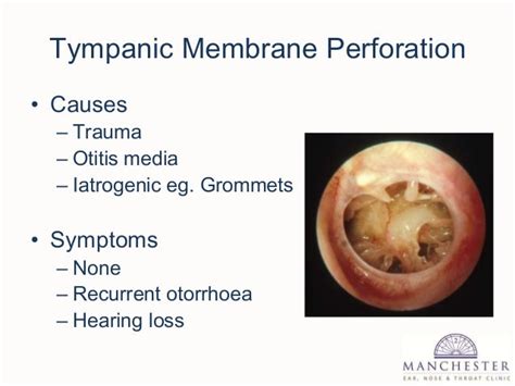 Tympanic Membrane Perforation Cause Symptoms Role Of