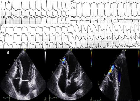 Desarrollo Del Tabique Interventricular Desarrollo Del Tabique Interventricular