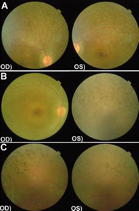Fundus Photograps Of Affected Individuals Funduscopy Photographs Of Download Scientific