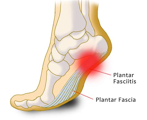 Plantar Fascia Pain