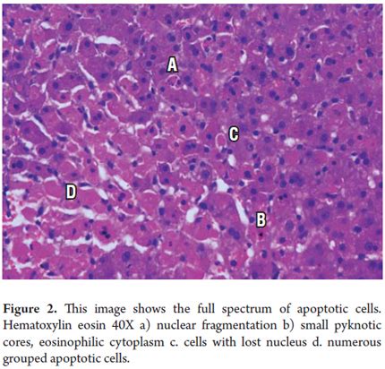 Hepatitis B Liver Histology
