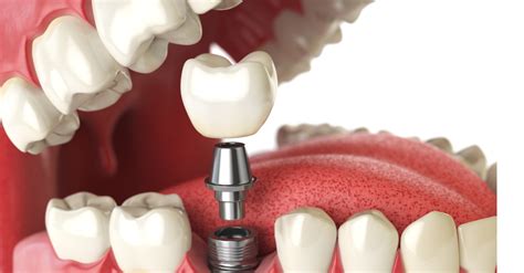 Permanent Tooth Replacement With Dental Implants