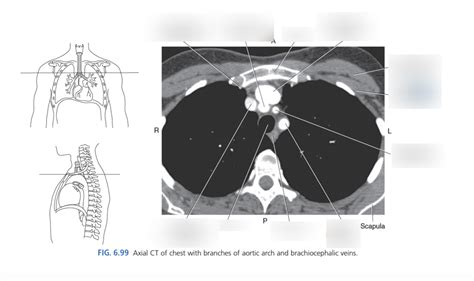 Diagram Of Axial Ct Of Branches Or Aortic Arch Quizlet