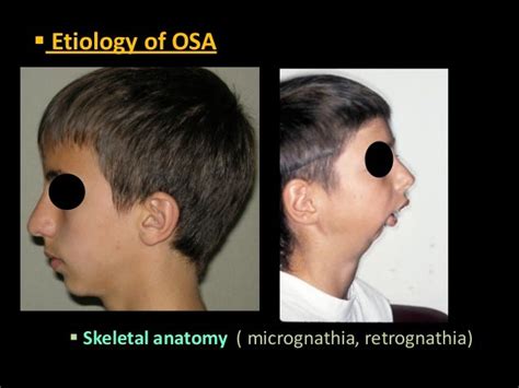 Obstructive Sleep Apnea