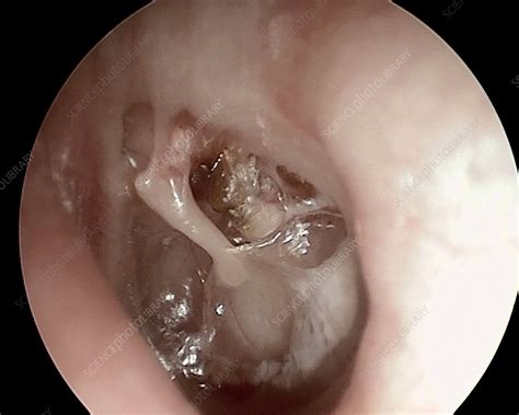Cholesteatoma Of The Eardrum Otoscope View Stock Image C038 5832 Science Photo Library