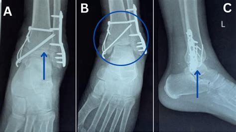 Physiotherapy Management Focusing On Early Mobilisation In Complex