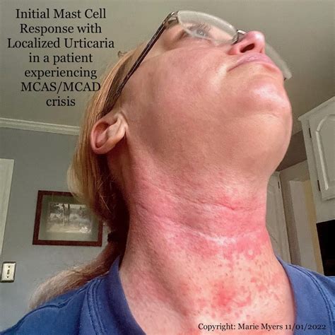 Not All Anaphylaxis Is Created Equal